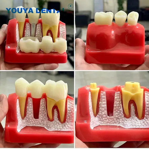 Modelo Dental De Implante Dental 4 Veces, Análisis