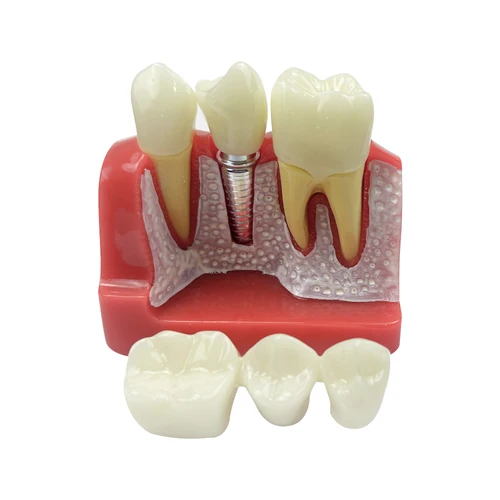 Modelo Dental De Implante Dental 4 Veces, Análisis
